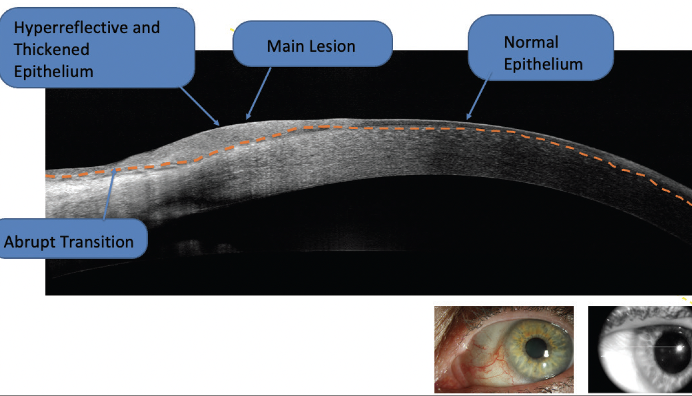 Performing an “Optical Biopsy” With HR-OCT - Modern Optometry