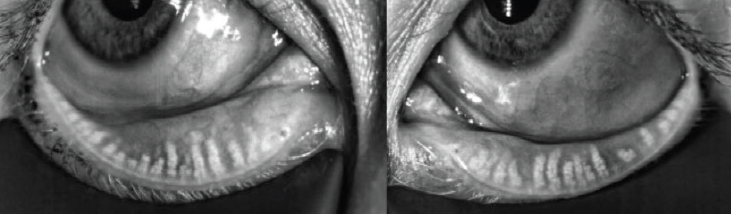 Vitamin A and OSD: the Good, the Bad, and the Ugly - Modern Optometry