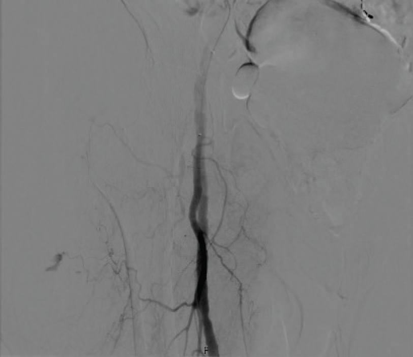 Penumbra Embolization Platform: A Coil for Every Case - Endovascular Today