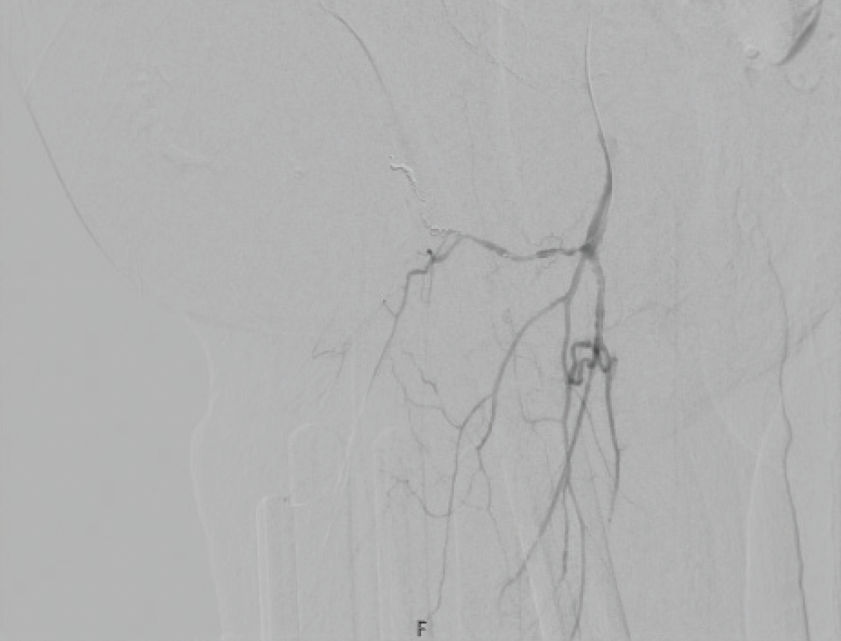 Penumbra Embolization Platform: A Coil for Every Case - Endovascular Today