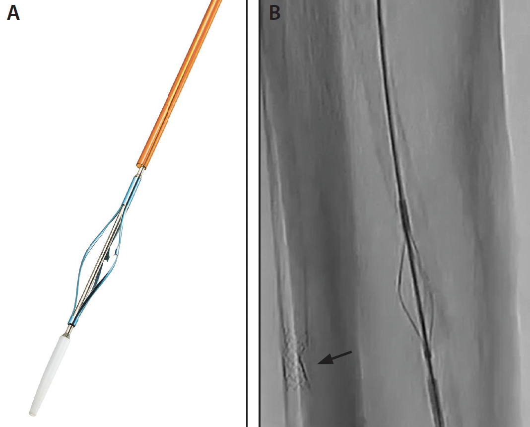 An Overview of the Inari LimFlow Procedure - Endovascular Today