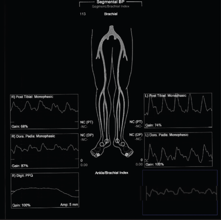 Shockwave Peripheral IVL: Size for Success - Endovascular Today
