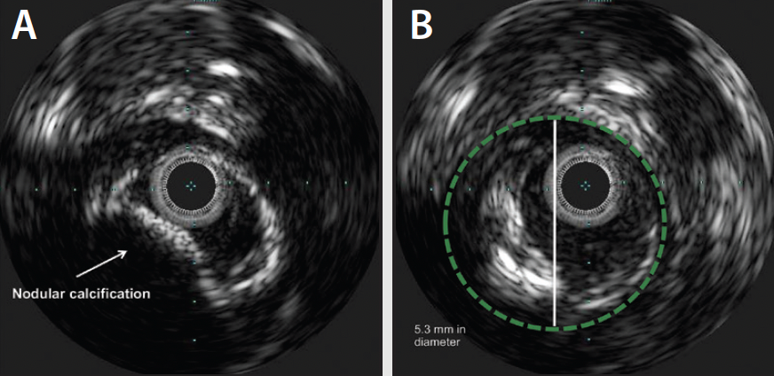 Shockwave Peripheral IVL: Size for Success - Endovascular Today