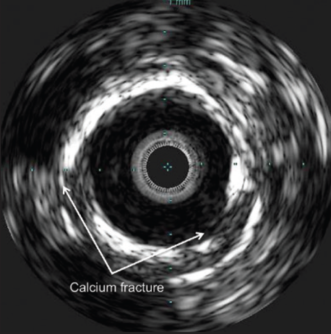 Shockwave Peripheral IVL: Size for Success - Endovascular Today