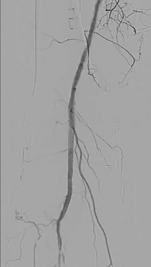 Shockwave Peripheral IVL: Size for Success - Endovascular Today