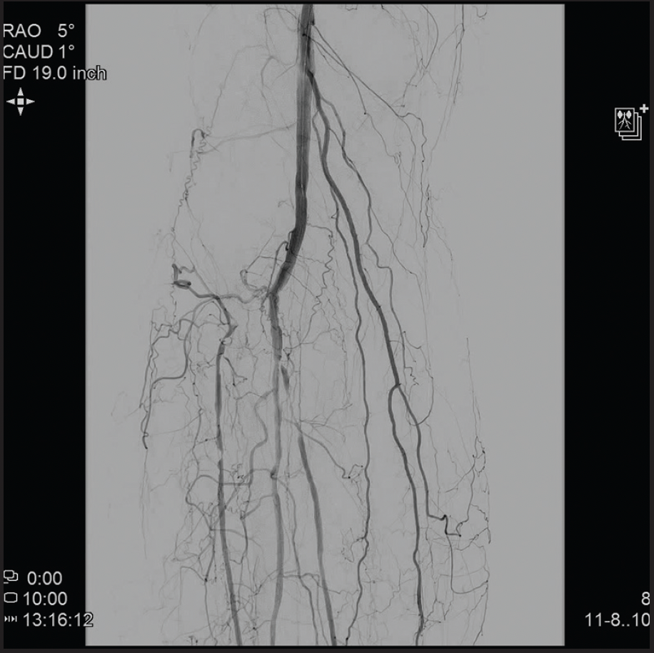 Shockwave Peripheral IVL: Size for Success - Endovascular Today
