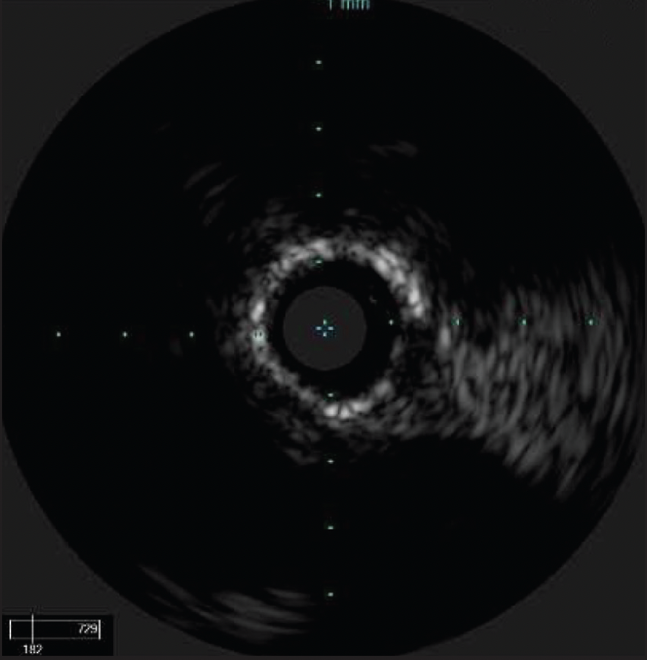 Shockwave Peripheral IVL: Size for Success - Endovascular Today