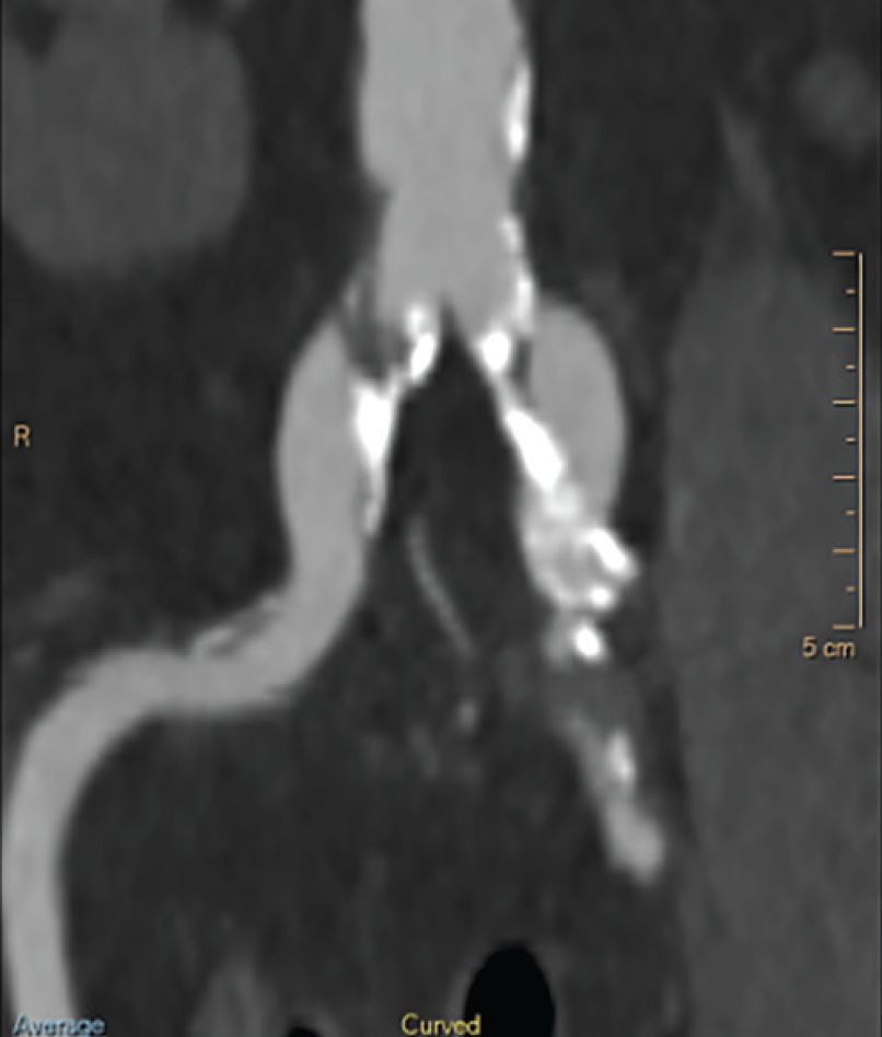 Shockwave Peripheral IVL: Size for Success - Endovascular Today