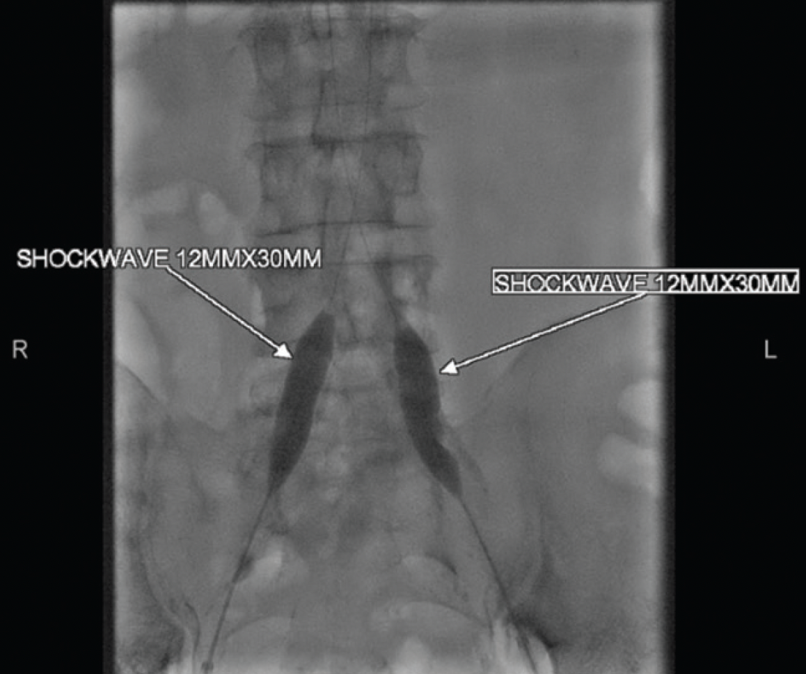 Shockwave Peripheral IVL: Size for Success - Endovascular Today