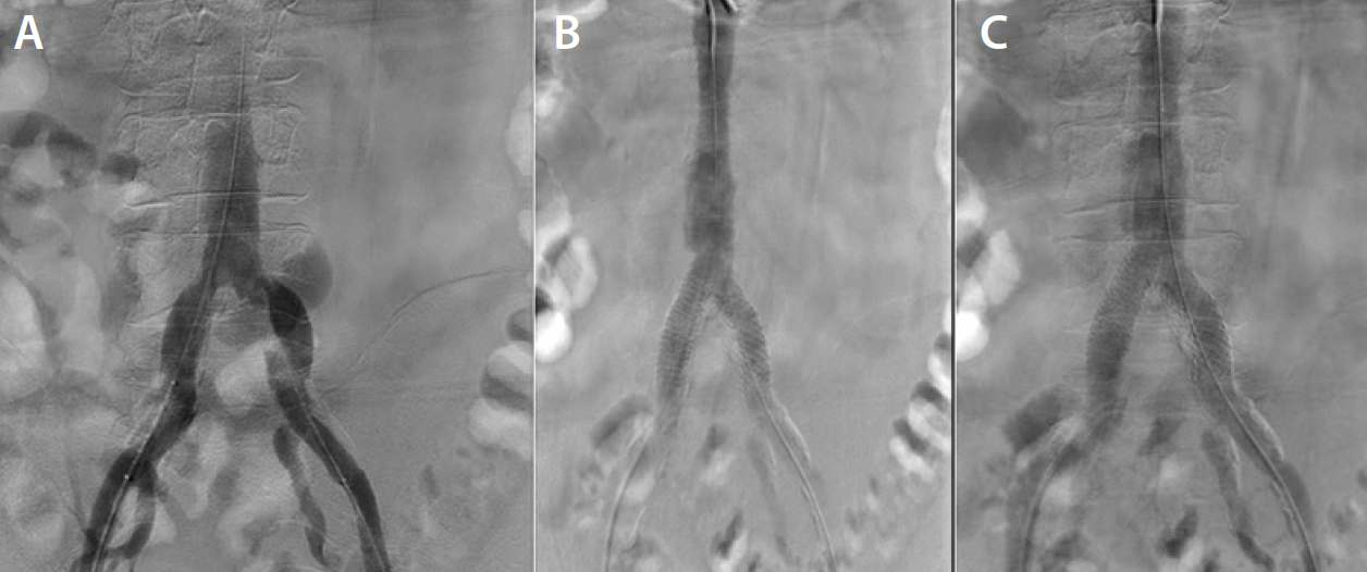Shockwave Peripheral IVL: Size for Success - Endovascular Today