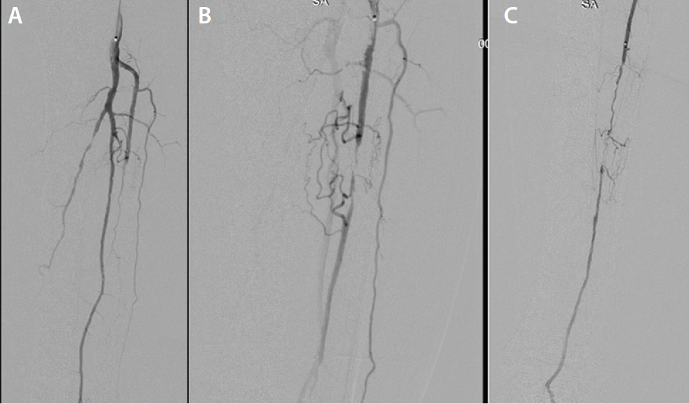 Shockwave Peripheral IVL: Size for Success - Endovascular Today