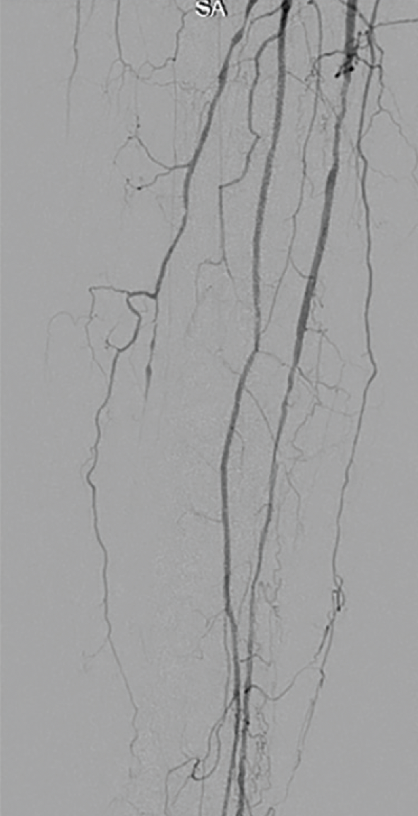 Shockwave Peripheral IVL: Size for Success - Endovascular Today