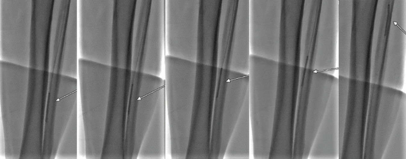 Shockwave Peripheral IVL: Size for Success - Endovascular Today