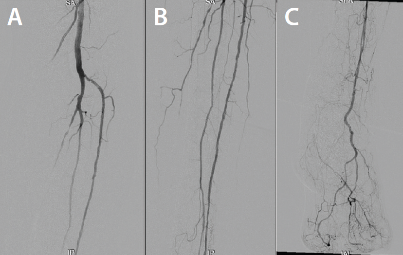Shockwave Peripheral IVL: Size for Success - Endovascular Today