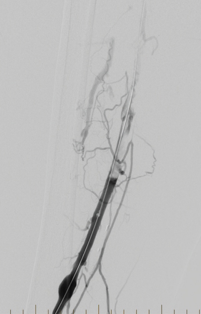 Safety. Effectiveness. Evidence. SEE Why Inari Is the Preferred Choice ...