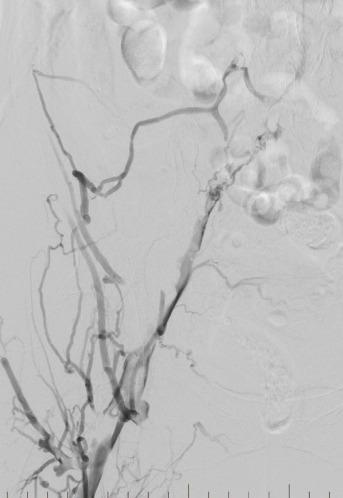 Safety. Effectiveness. Evidence. SEE Why Inari Is the Preferred Choice ...