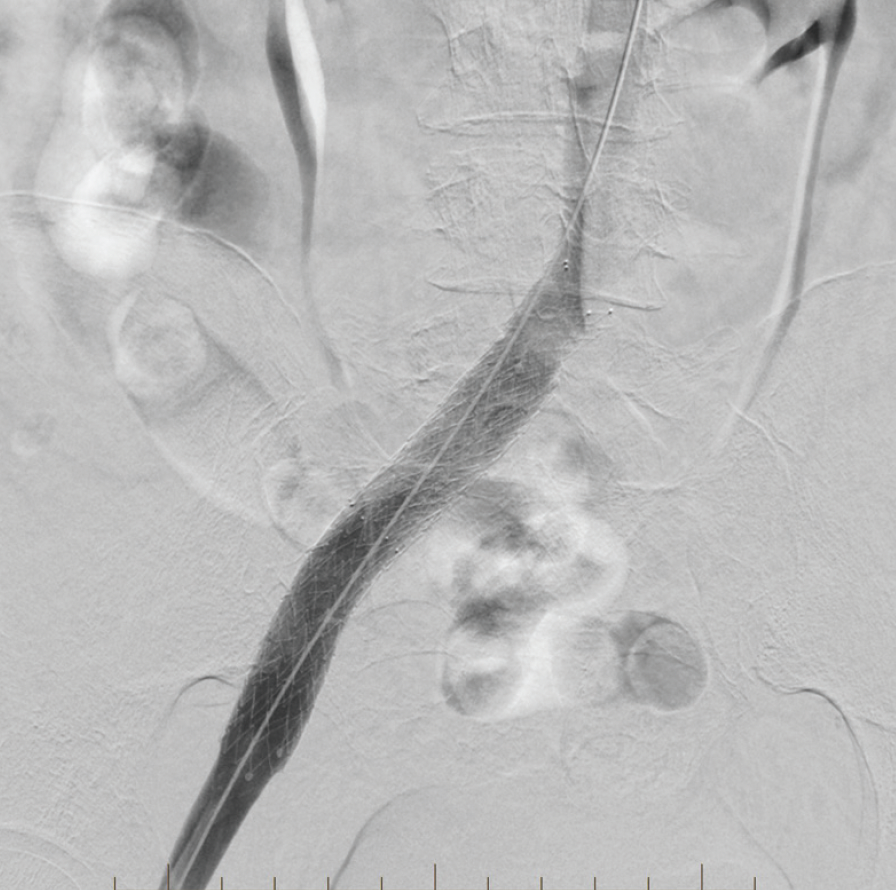 Safety. Effectiveness. Evidence. SEE Why Inari Is the Preferred Choice ...