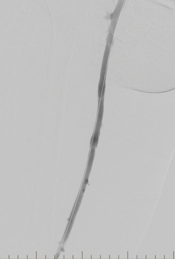 Safety. Effectiveness. Evidence. SEE Why Inari Is the Preferred Choice ...