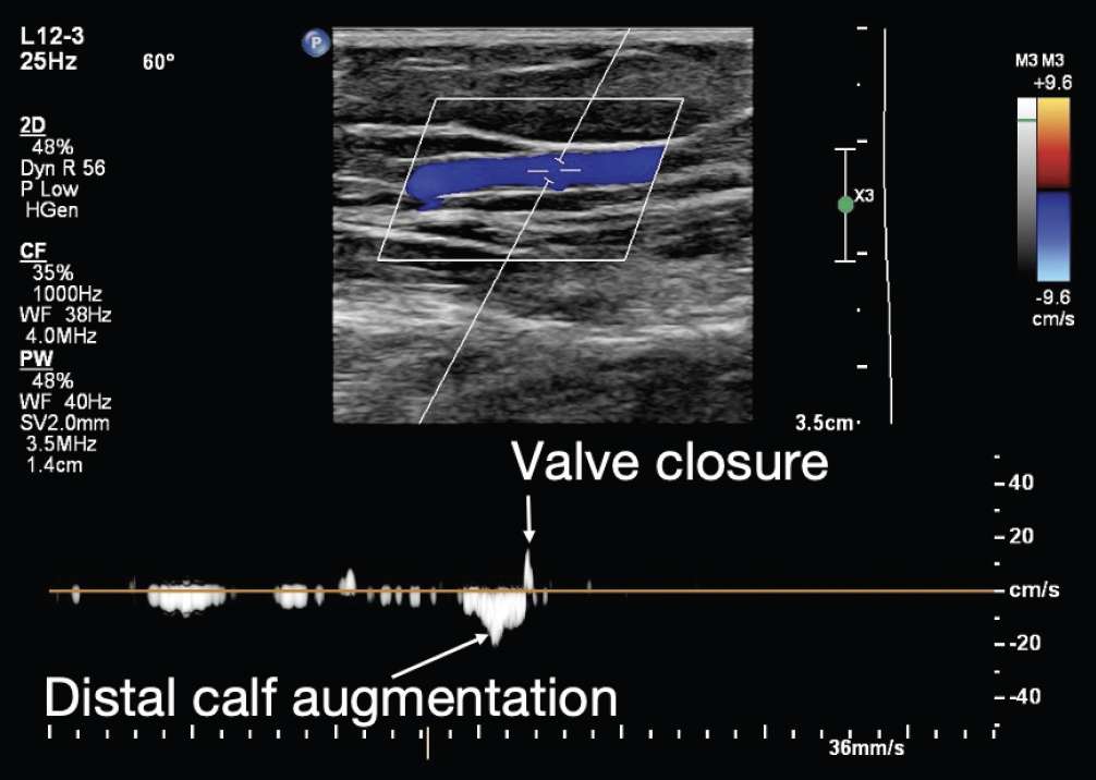 Current Diagnostic Strategies for Superficial Venous Insufficiency ...