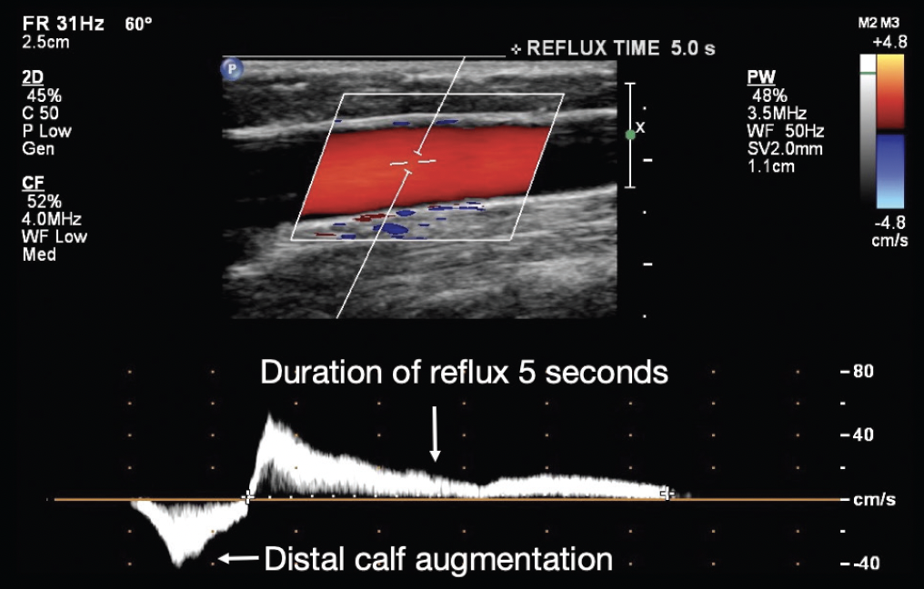 Current Diagnostic Strategies for Superficial Venous Insufficiency ...