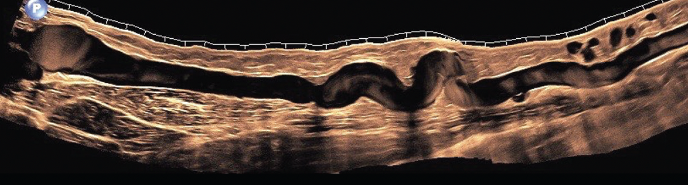 Current Diagnostic Strategies for Superficial Venous Insufficiency ...
