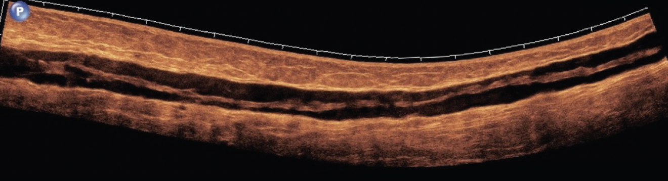 Current Diagnostic Strategies for Superficial Venous Insufficiency ...