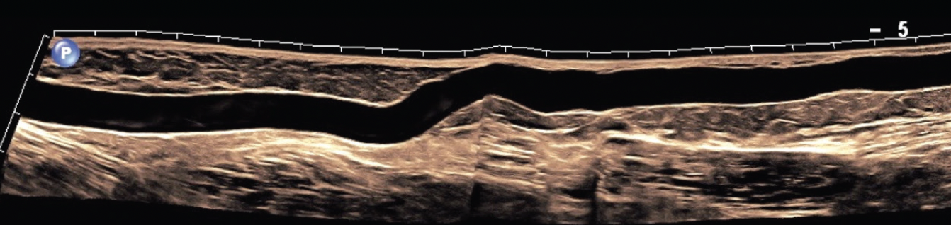 Current Diagnostic Strategies for Superficial Venous Insufficiency ...