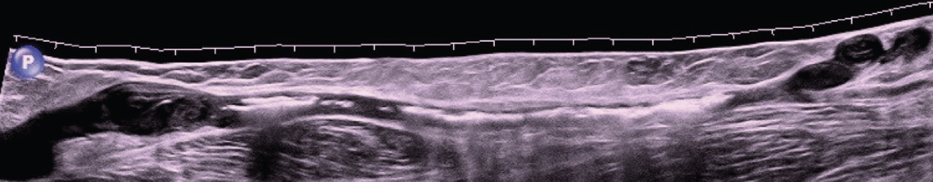 Current Diagnostic Strategies for Superficial Venous Insufficiency ...