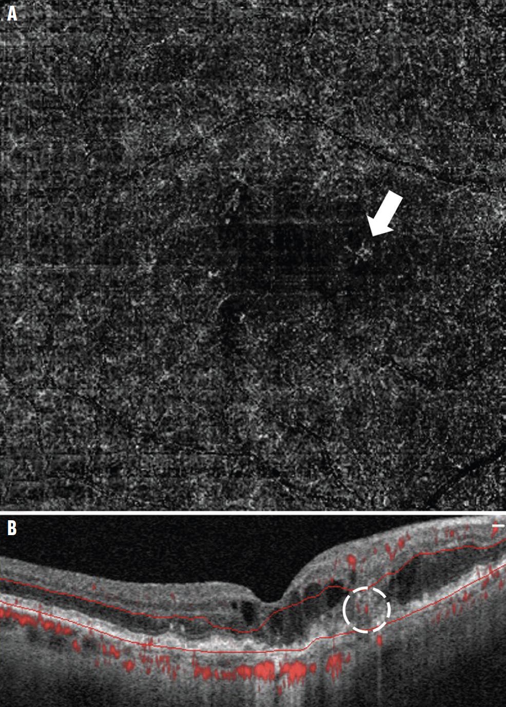 A Reference Guide For Oct Angiography Retina Today