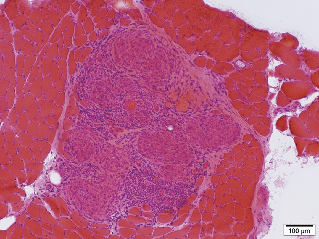 Neuromuscular Sarcoidosis: Peripheral Nervous System Manifestations ...