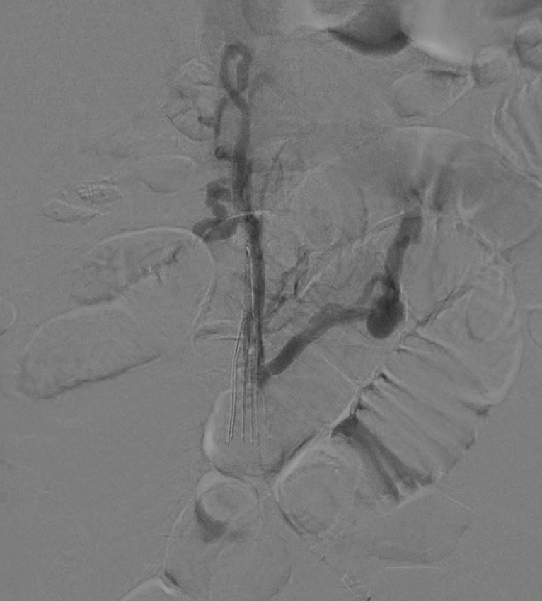 Filter-Associated Inferior Vena Cava Thrombosis - Endovascular Today