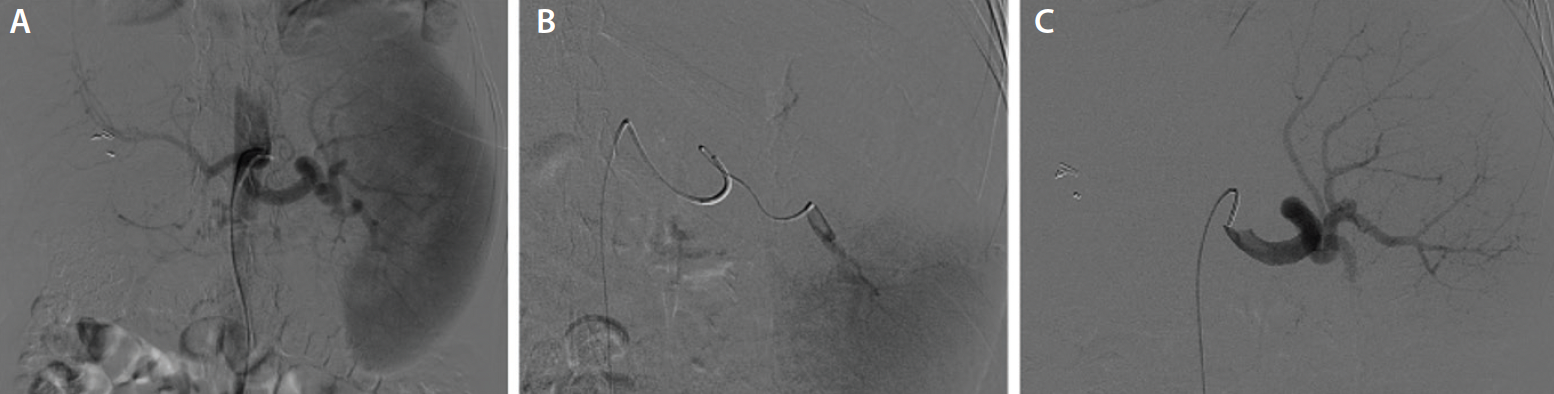 Splenic Artery Embolization for Bleeding Gastroesophageal Varices ...