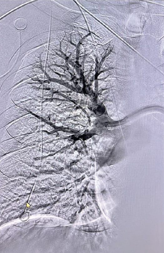 Computer Assisted Vacuum Thrombectomy (CAVT): The Future of Thrombus ...