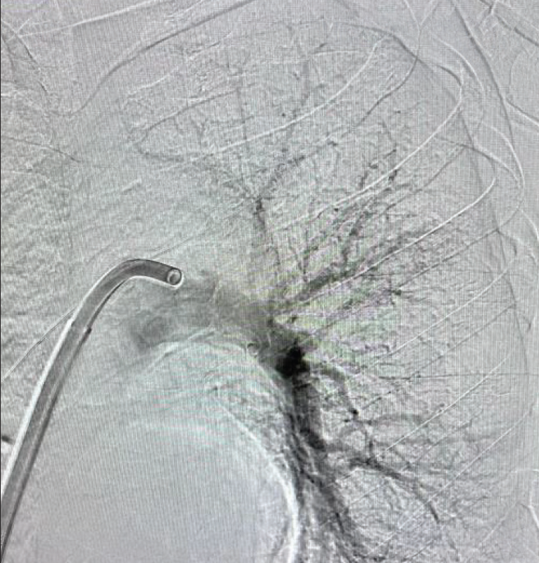 Computer Assisted Vacuum Thrombectomy (CAVT): The Future of Thrombus ...