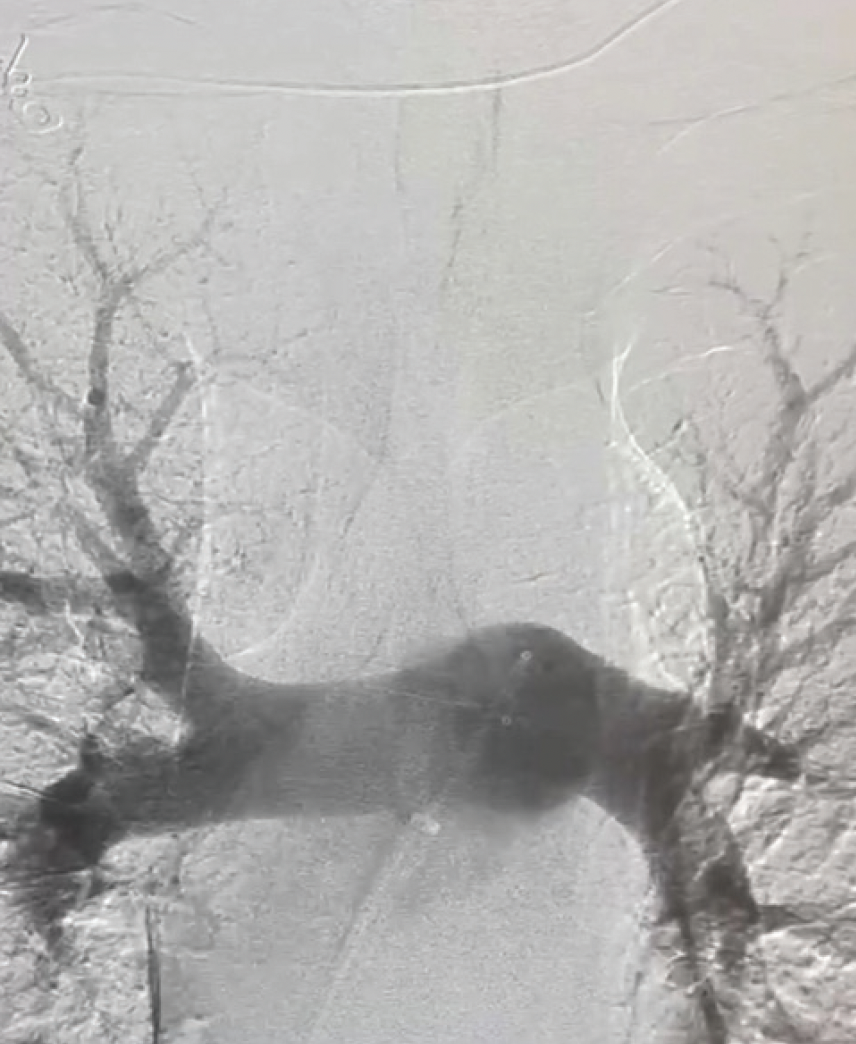 Computer Assisted Vacuum Thrombectomy (CAVT): The Future of Thrombus ...