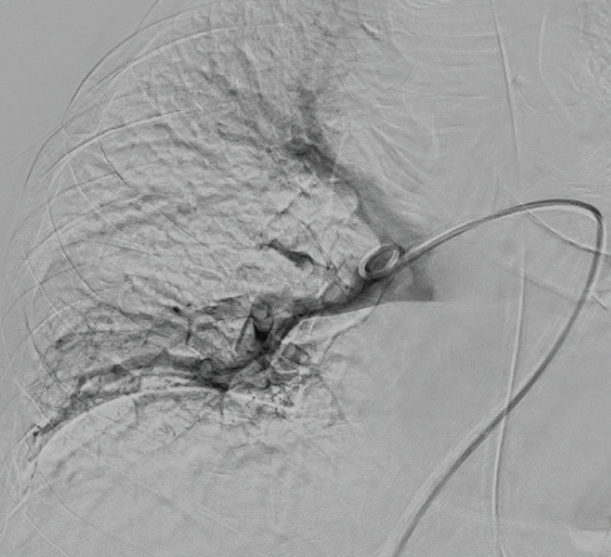 Computer Assisted Vacuum Thrombectomy (CAVT): The Future of Thrombus ...