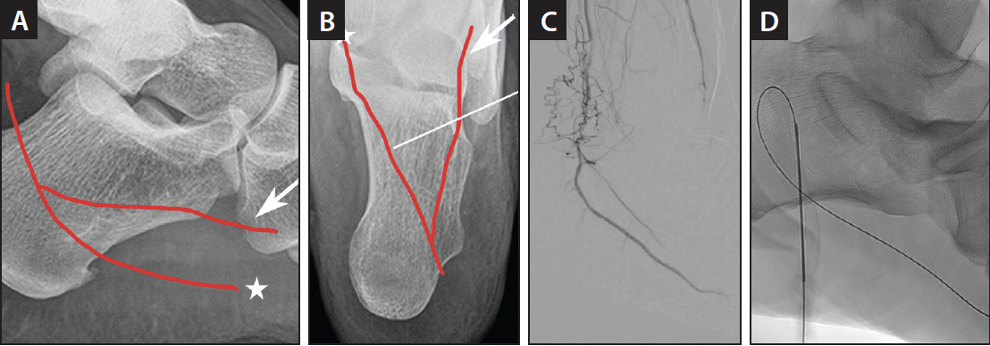 Distal Plantar Access: How We Do It - Endovascular Today
