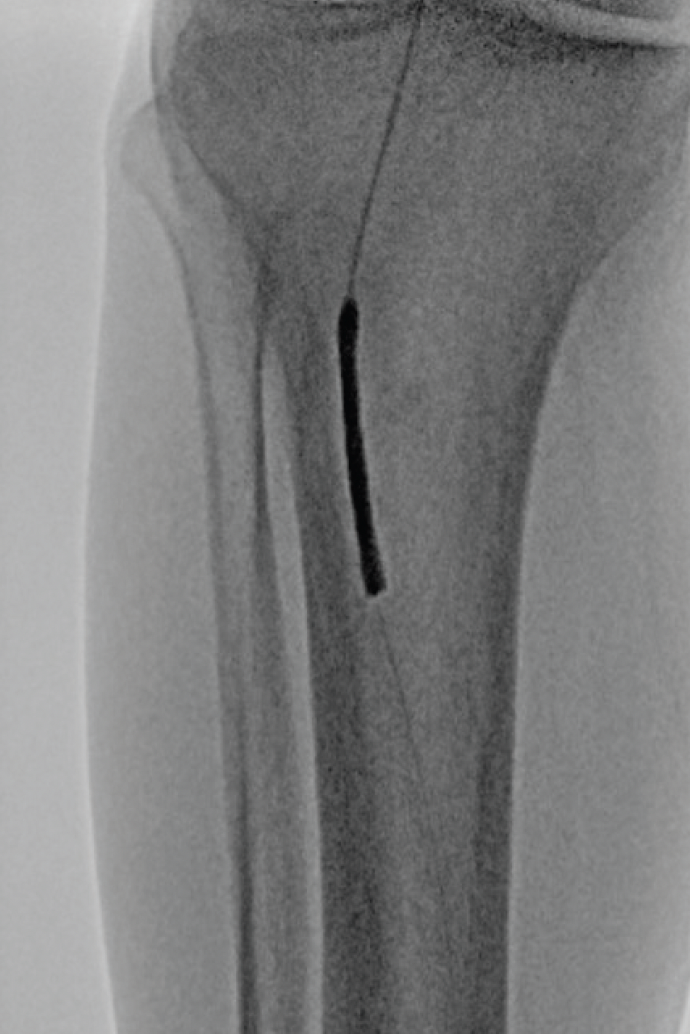 Innovation With Serration: Advances in BTK Care With the Serranator ...