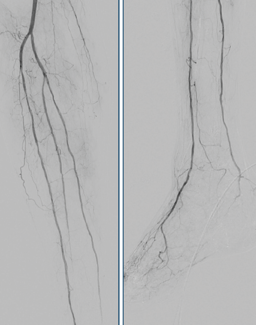 Innovation With Serration: Advances in BTK Care With the Serranator ...