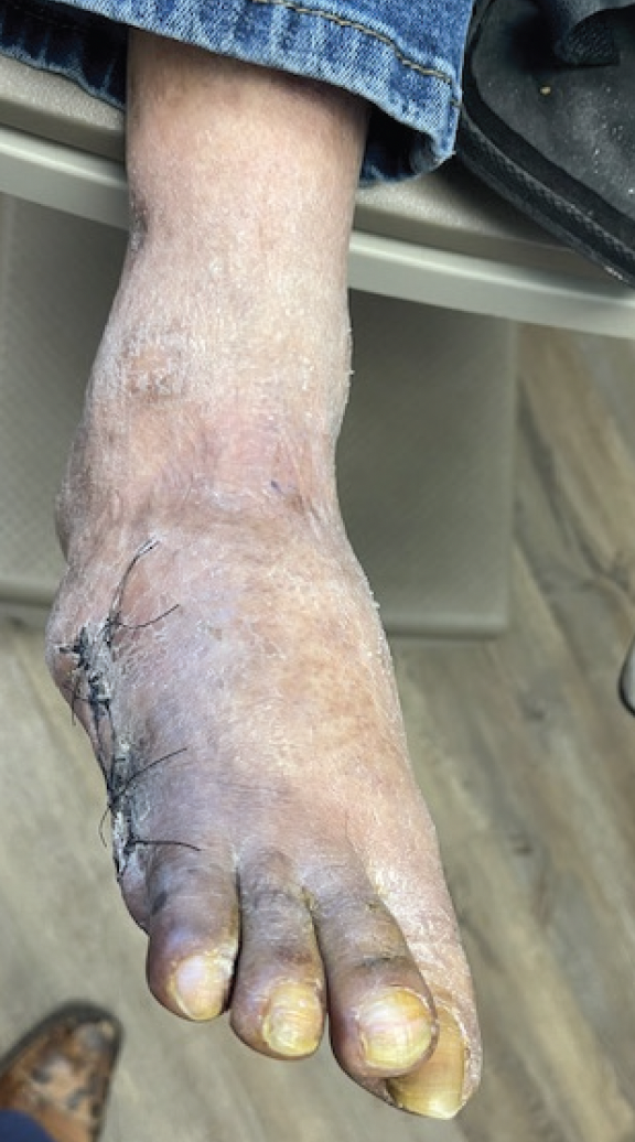 Innovation With Serration: Advances in BTK Care With the Serranator ...