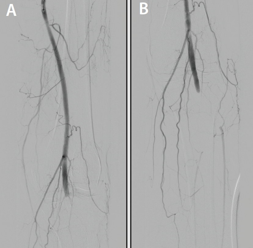 Case Report: Successful Removal of Organized TPT, PT, and AT Thrombus ...