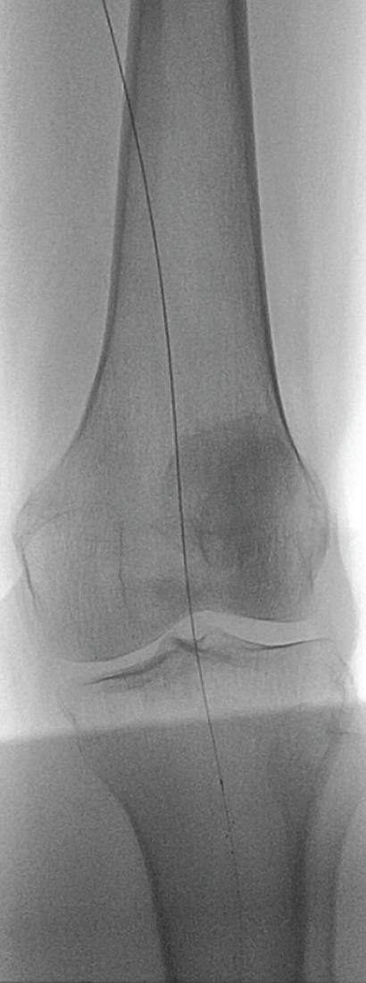 Case Report: Successful Removal of Organized TPT, PT, and AT Thrombus ...