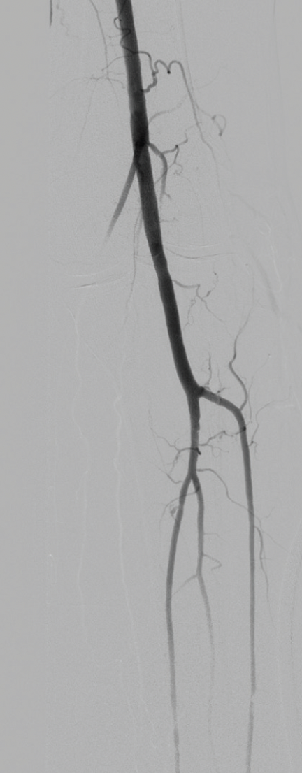 Case Report: Successful Removal of Organized TPT, PT, and AT Thrombus ...