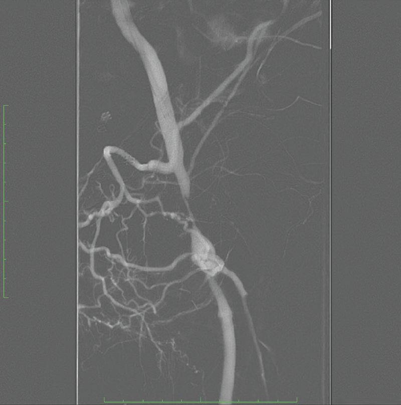 Case Report: Successful Revascularization of a 99% Left CFA Stenosis ...