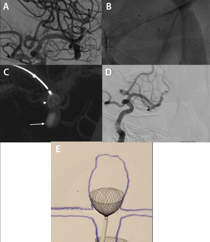 Tips and Pitfalls of New Endosaccular Aneurysm Technology ...