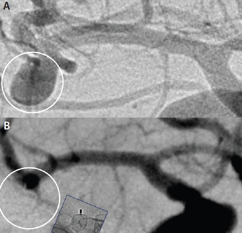 Tips and Pitfalls of New Endosaccular Aneurysm Technology ...
