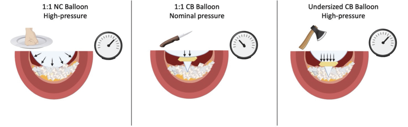 Cutting and Scoring Balloons - Cardiac Interventions Today