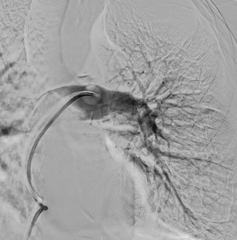 Lightning Flash 2.0: Next-Gen Software for the Treatment of PE ...