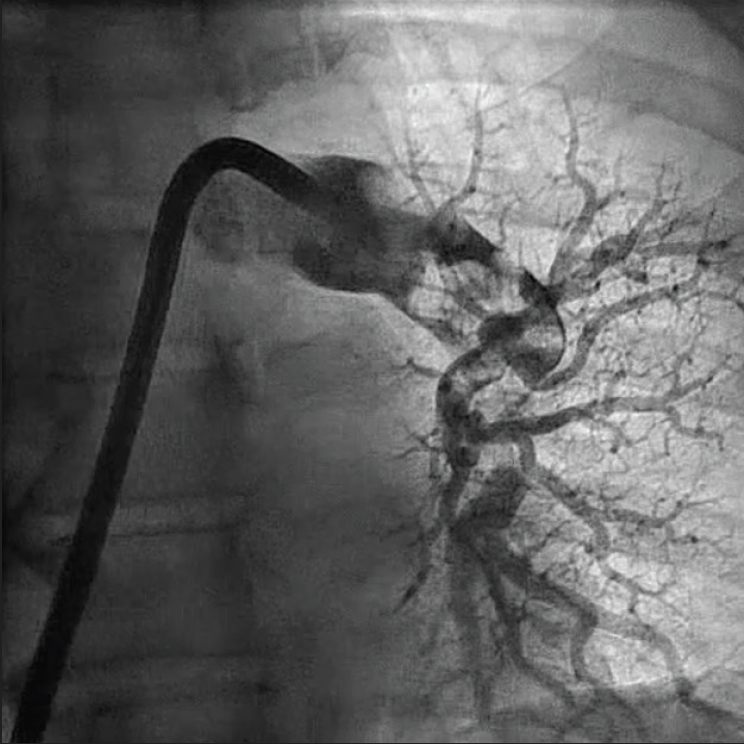 Lightning Flash 2.0: Next-Gen Software for the Treatment of PE ...