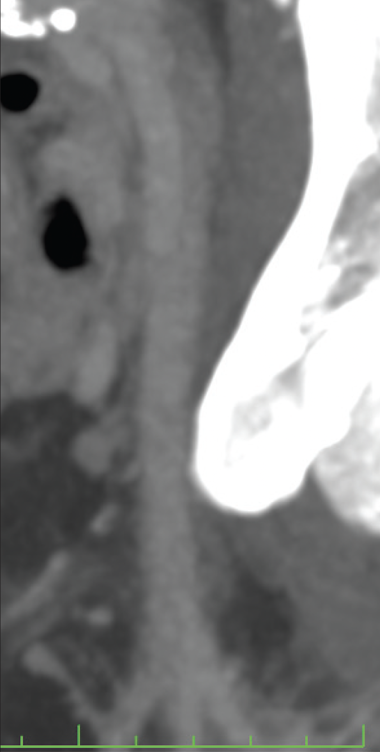 Real-World Experience With Computer Assisted Vacuum Thrombectomy (CAVT ...